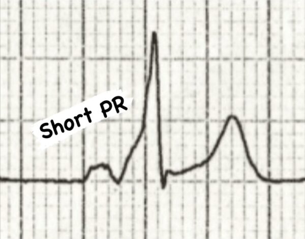 Wolff-Parkinson-White Syndrome: What You Don’t See Can Hurt Them – AGC MED
